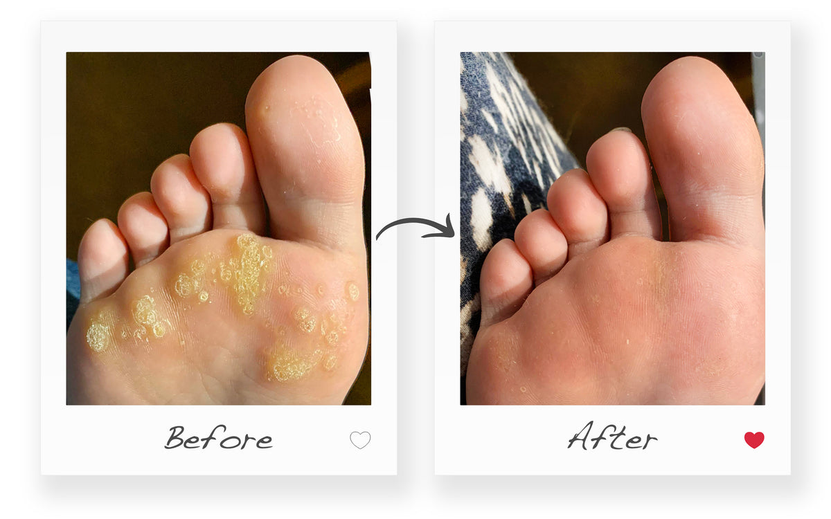 No More Plantar Warts or Verrucas!